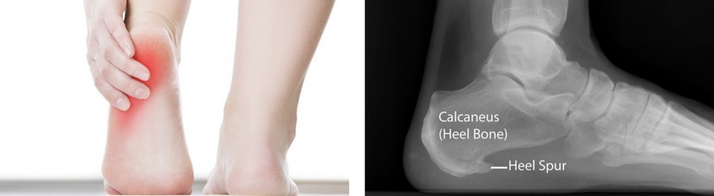 What Are Heel Spurs? - AMA Podiatry